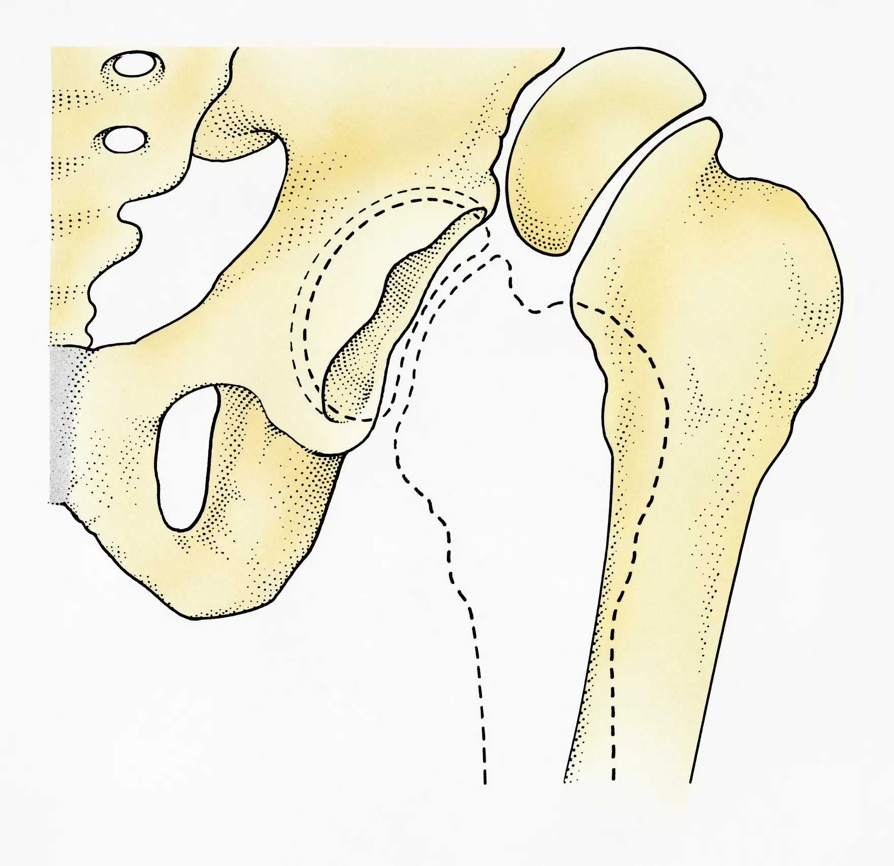 Slipped Capital Femoral Epiphysis | Treated by Children Specialists